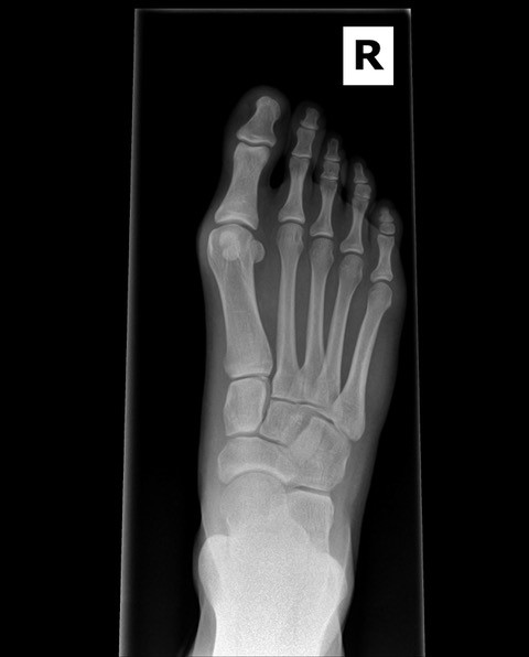 Understanding Minimal Incision Bunion Surgery | Upperline Health